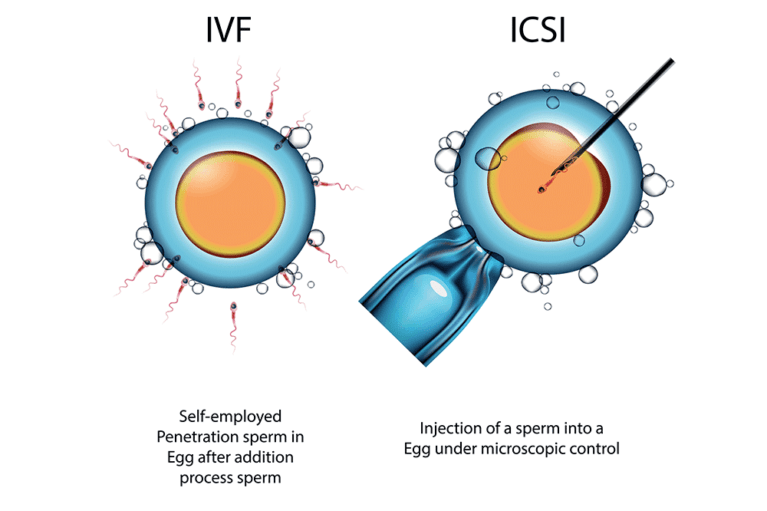 IVF Vs ICSI | Difference Between IVF and ICSI