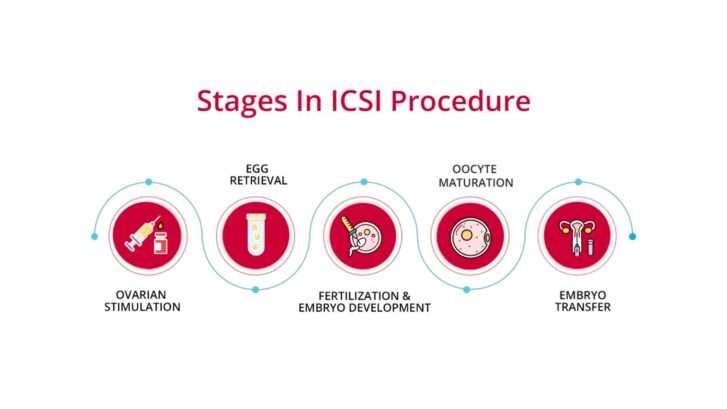ICSI Treatment Procedure, Success Rate & Cost in Pakistan